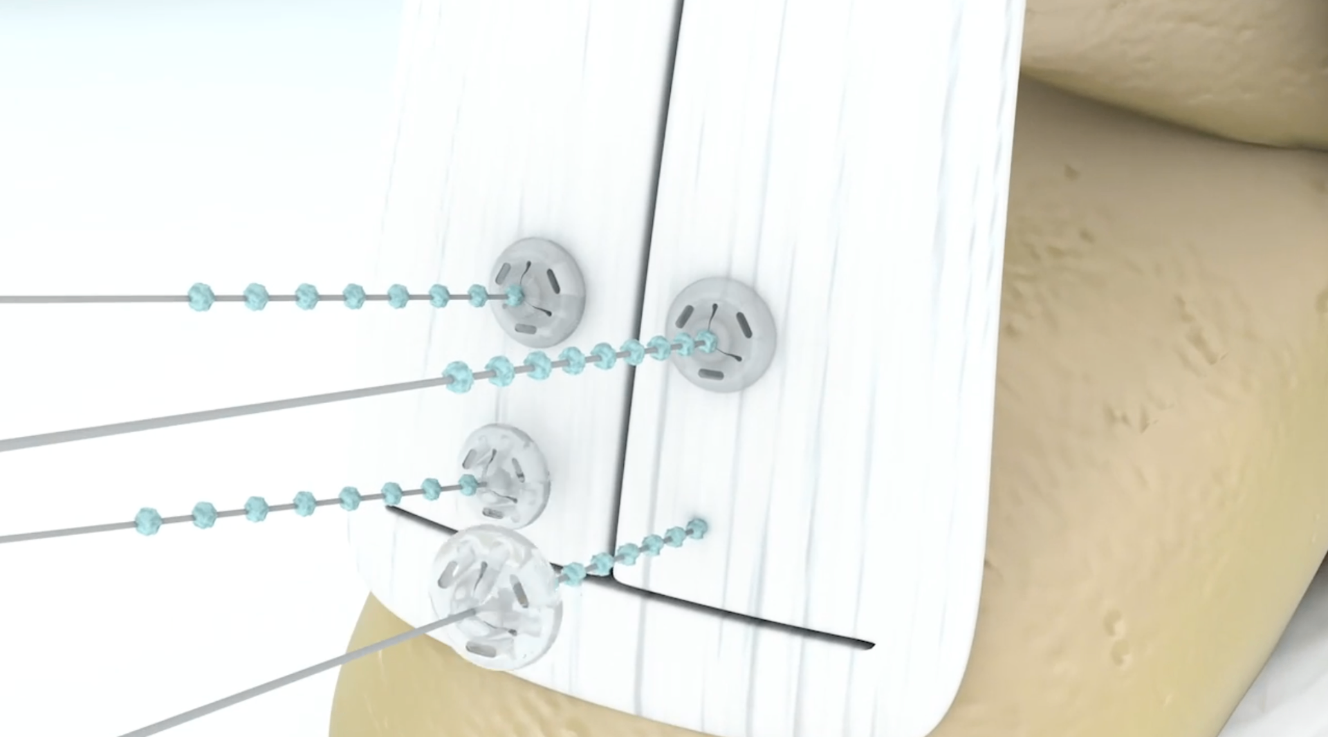 ZipTek Global - Surgical Repair Technology | Resorbable Locking Systems